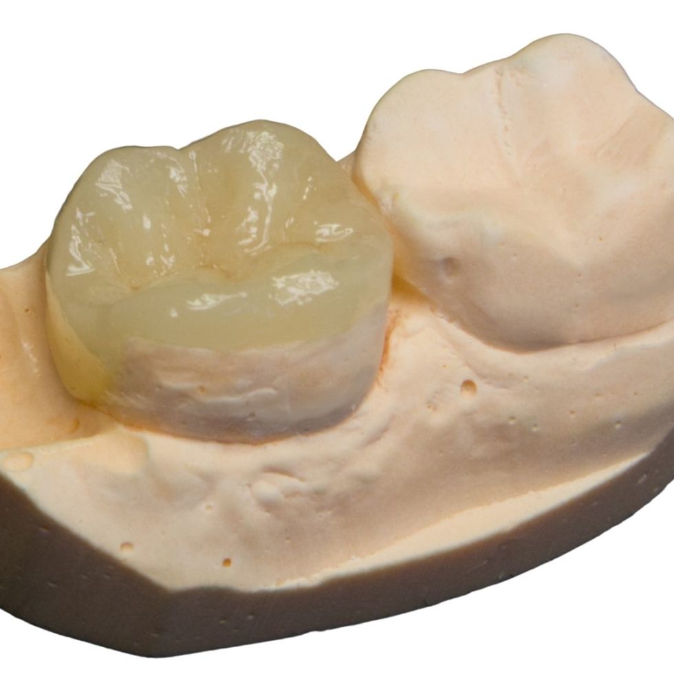 Inlay, onlay, overlay - Poliklinika Petković